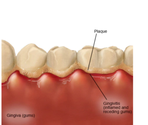 Gum Health and It’s Importance - Prakash Dental Care