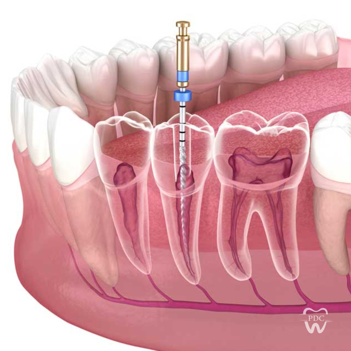 What to Expect During Your Root Canal Treatment? A Complete Patient Guide